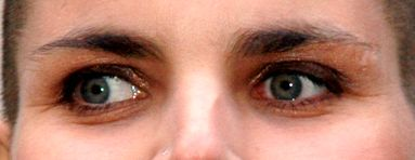 Exotropia Eyes Memes